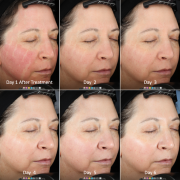 Grow Your Beauty Practice | UltraClear Laser