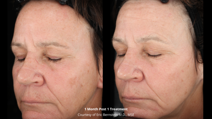 Skin Resurfacing and Rejuvenation Benefits | UltraClear Laser