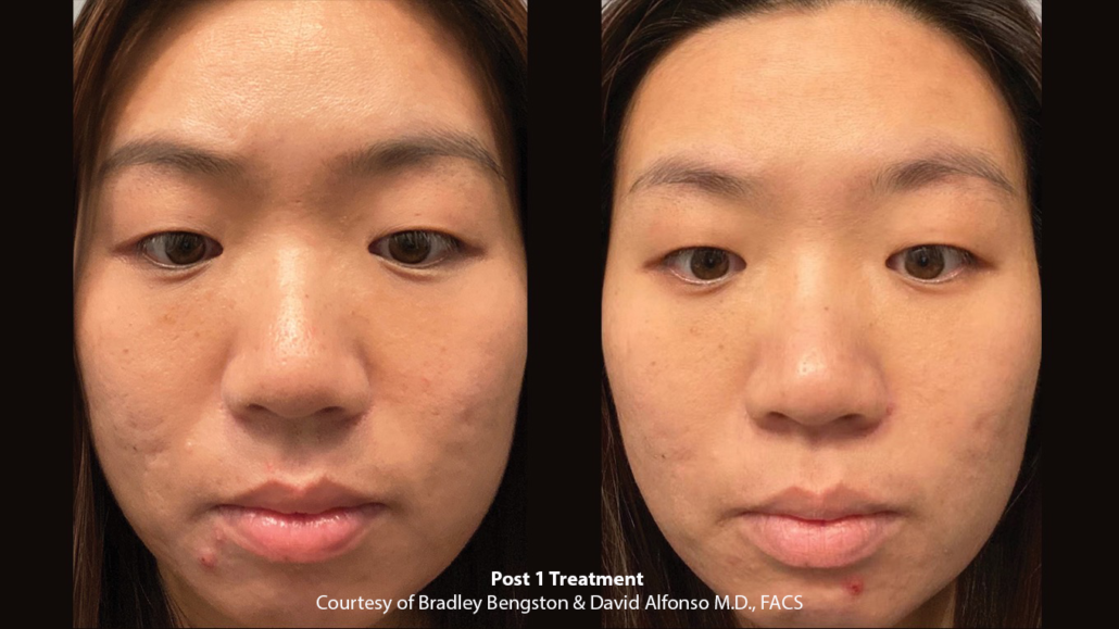 Rejuvenation and Resurfacing for Skin of Color | UltraClear Laser
