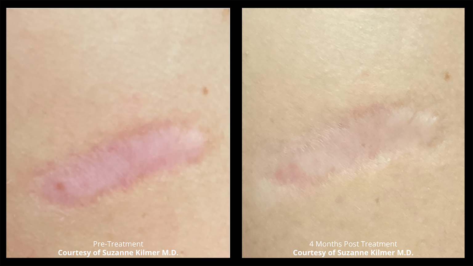 UltraClear Laser Skin Rejuvenation Solutions