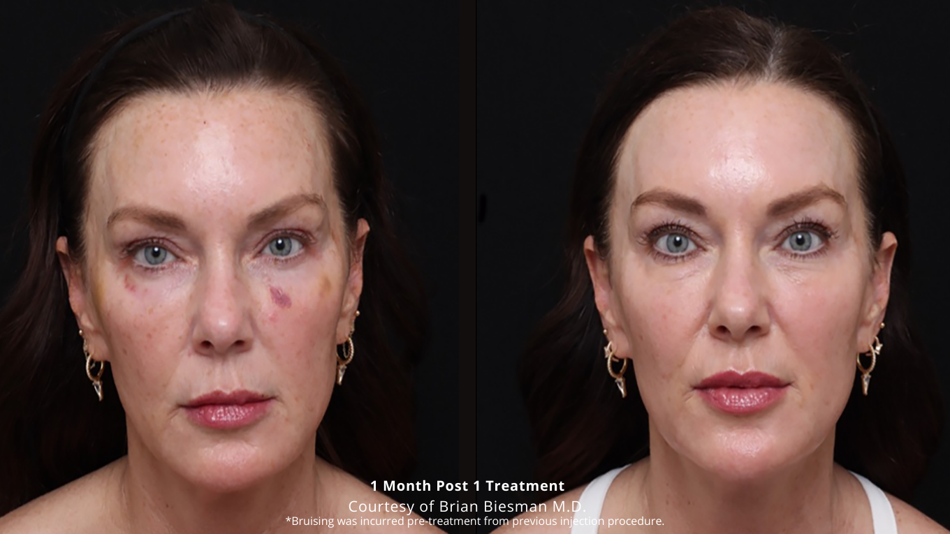 UltraClear Laser Skin Rejuvenation Solution