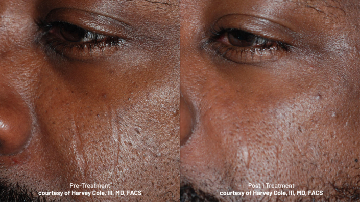 Rejuvenation and Resurfacing for Skin of Color | UltraClear Laser