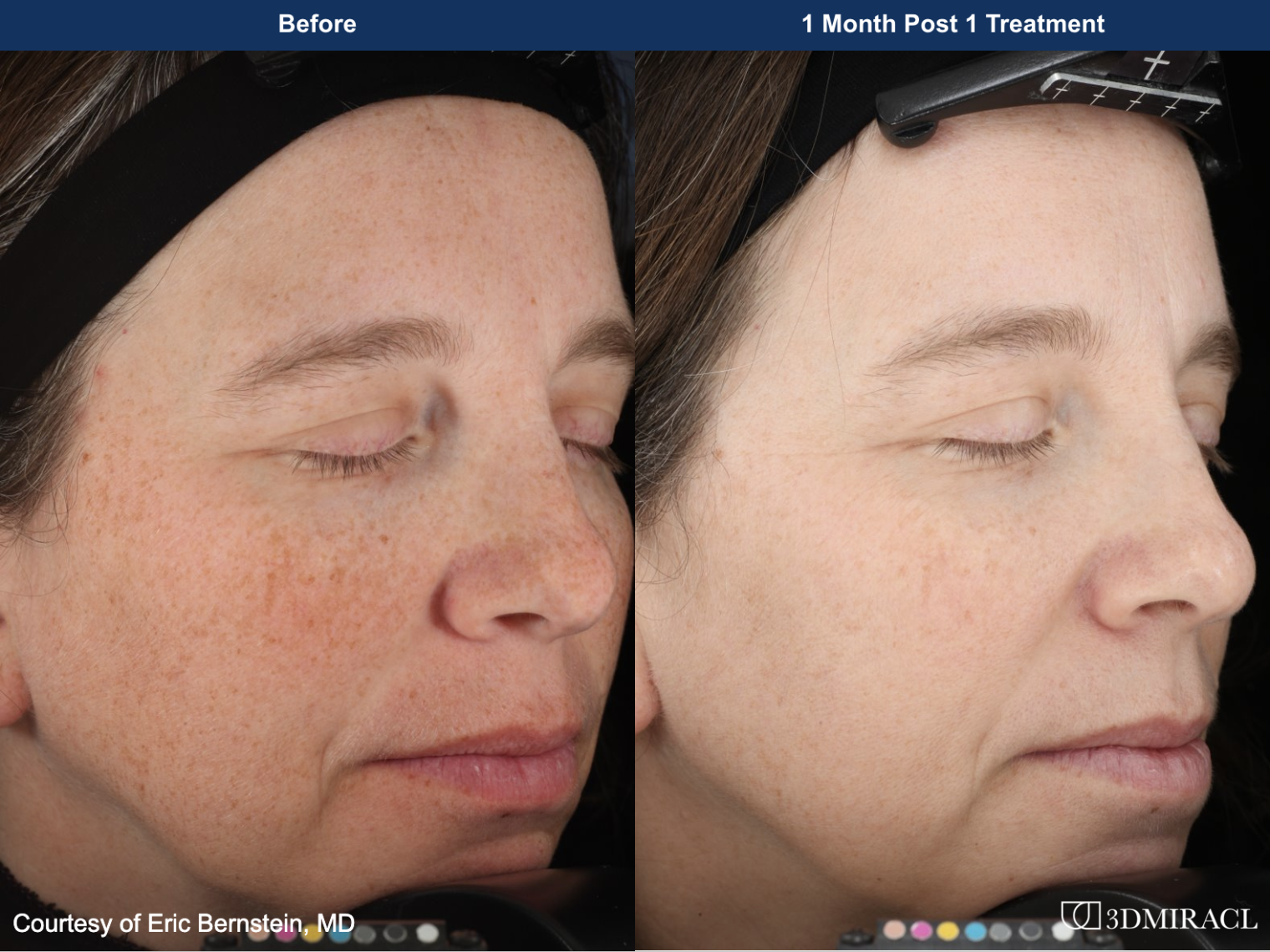 Frequently Asked Questions About 3DMIRACL™ Treatment and UltraClear® | UltraClear