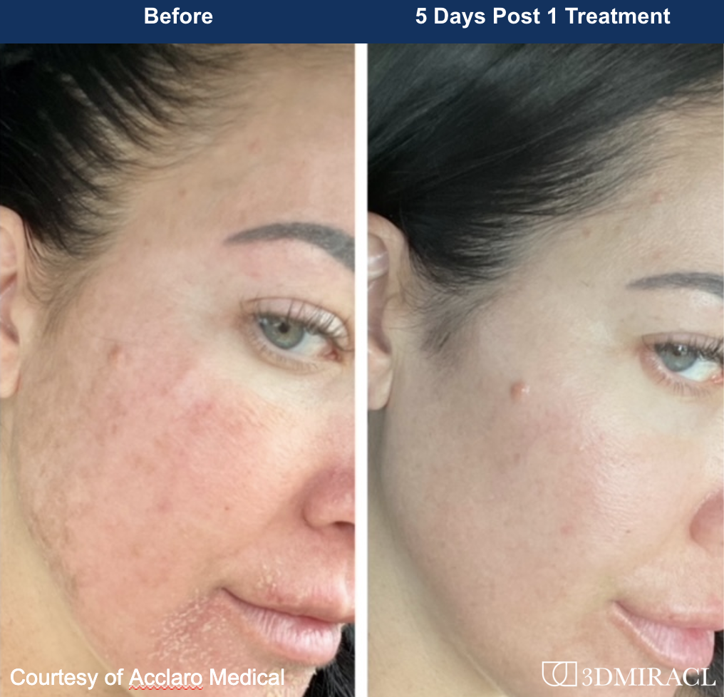 Frequently Asked Questions About 3DMIRACL™ Treatment and UltraClear ...