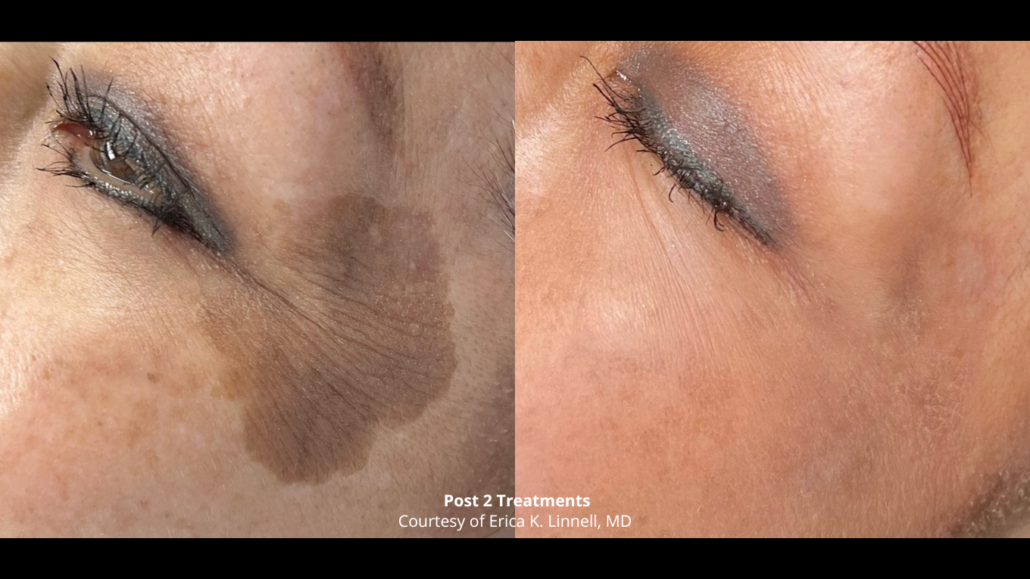 UltraClear Laser Skin Rejuvenation Solutions