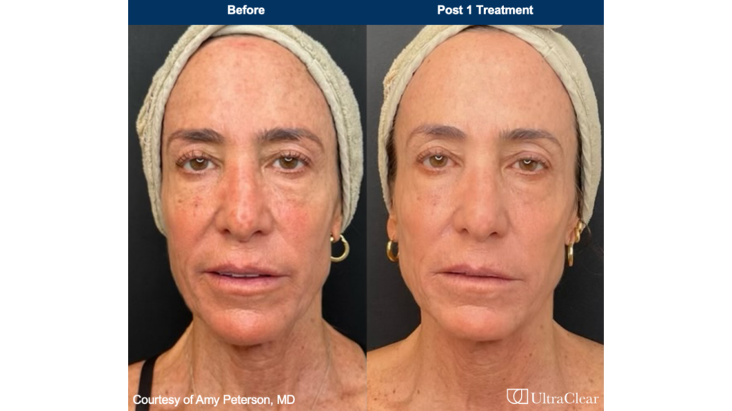 UltraClear Laser Skin Rejuvenation Solutions