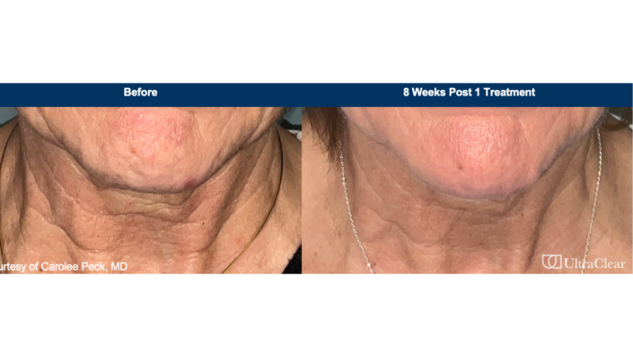 UltraClear Laser Skin Rejuvenation Solutions