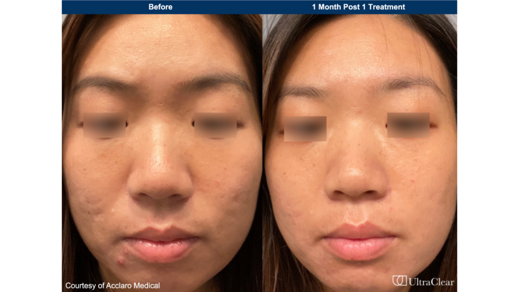 UltraClear Laser Skin Rejuvenation Solutions