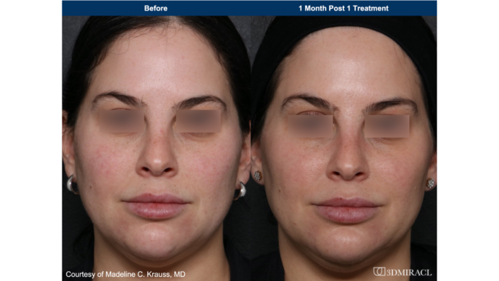 UltraClear Laser Skin Rejuvenation Solutions