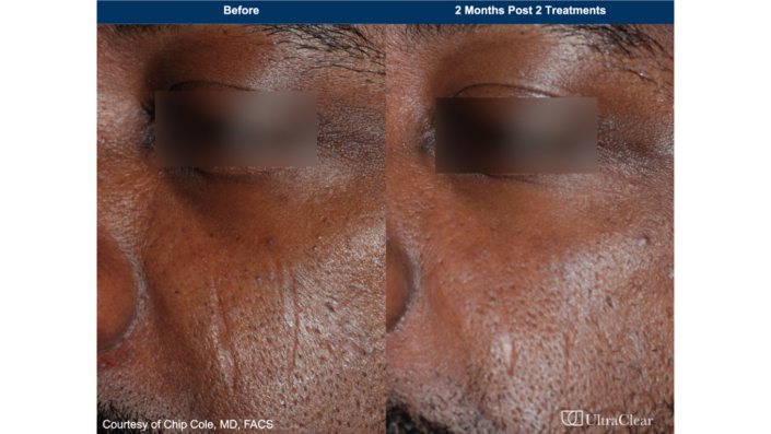 UltraClear Laser Skin Rejuvenation Solutions