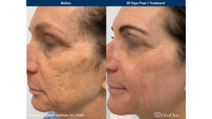 UltraClear Laser Skin Rejuvenation Solutions