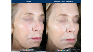 UltraClear Laser Skin Rejuvenation Solutions