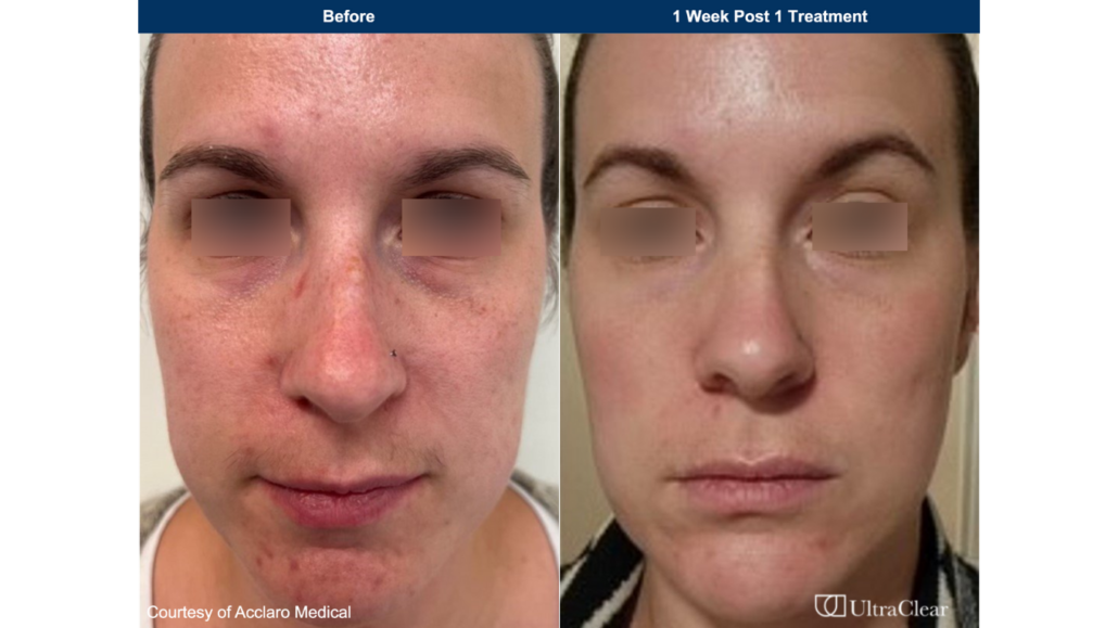 UltraClear Laser Skin Rejuvenation Solutions