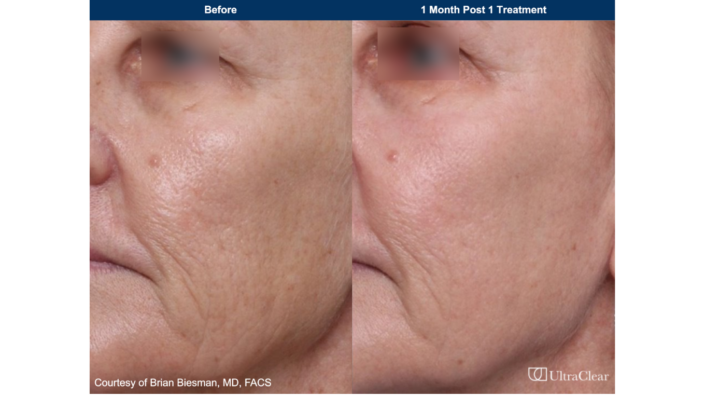 UltraClear Laser Skin Rejuvenation Solutions