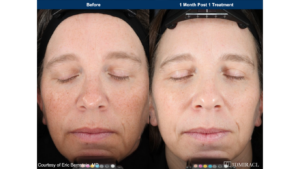 UltraClear Laser Skin Rejuvenation Solutions