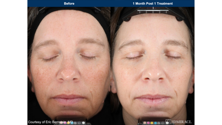 UltraClear Laser Skin Rejuvenation Solutions