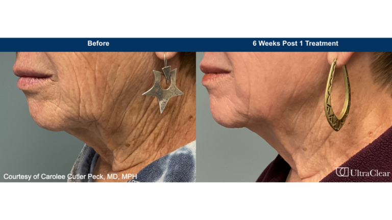 UltraClear Laser Skin Rejuvenation Solutions