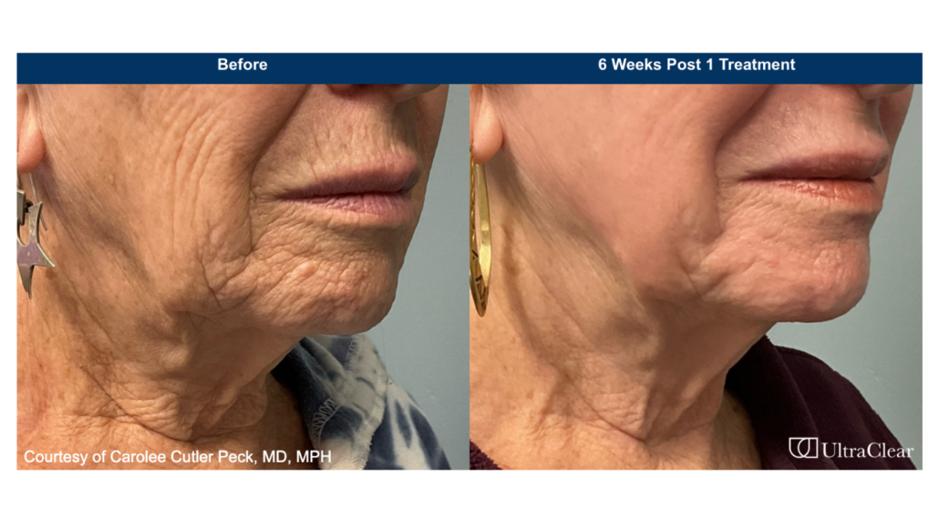 UltraClear Laser Skin Rejuvenation Solutions