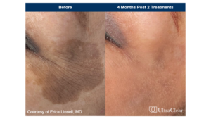 UltraClear Laser Skin Rejuvenation Solutions