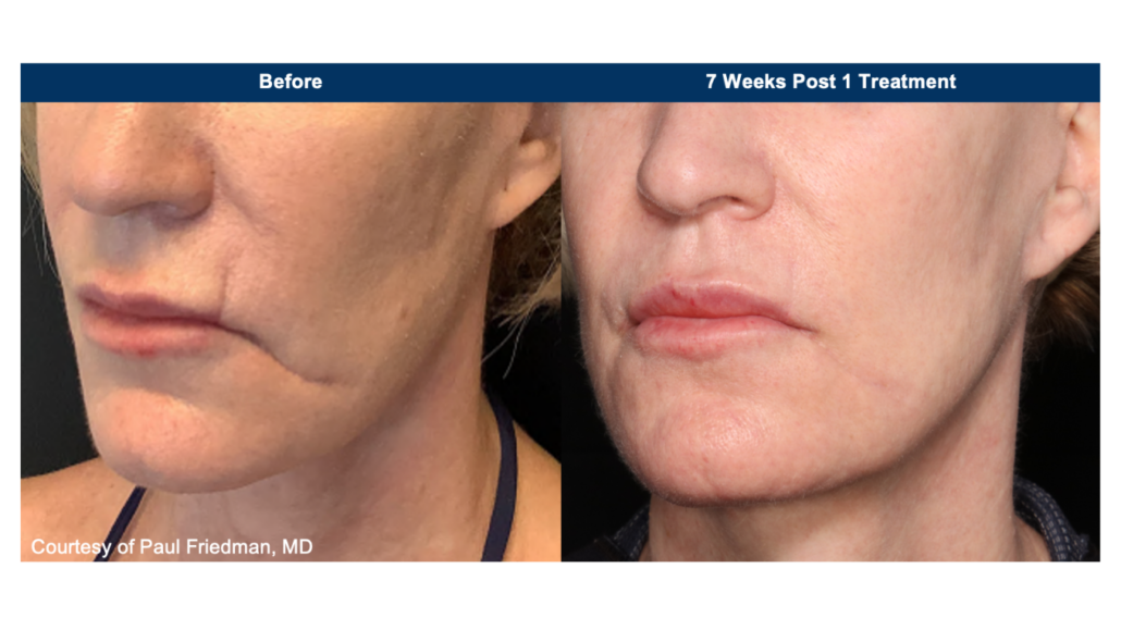 UltraClear Laser Skin Rejuvenation Solutions