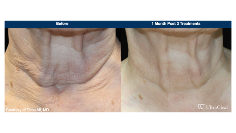 UltraClear Laser Skin Rejuvenation Solutions